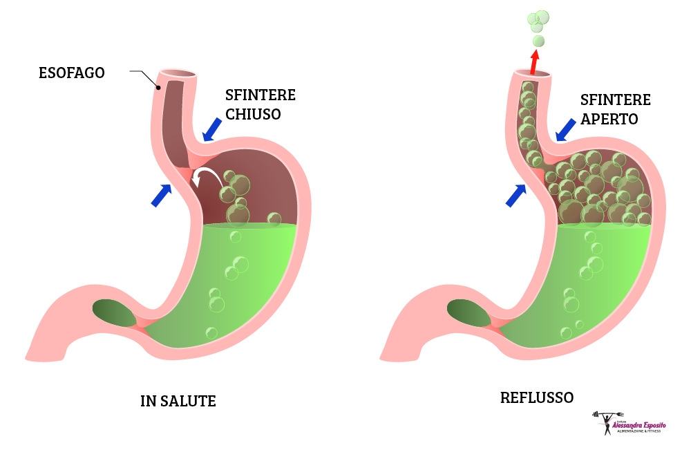 Dieta antireflusso e le 8 cose da evitare (comprovata)